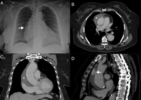 Aneurysm And Dissection In A Patient With Syphilitic Aortitis The