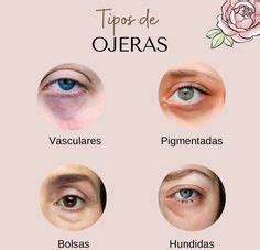 Tipos De Ojeras Tipos De Ojo Tipos De Ojos Ojeras