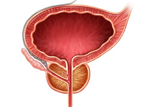 Prostate Stones Prostatic Calculi Or Prostate Calculi Causes
