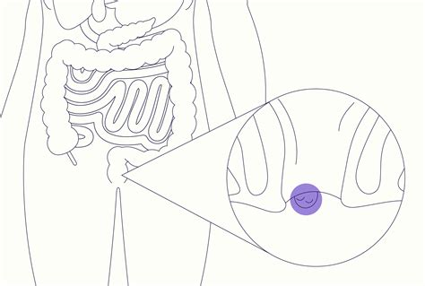 Mild Hemorrhoids Symptoms