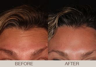 DAXXIFY Gallery Aging On Forehead And Glabella