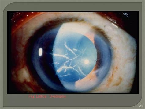 Corneal Degeneration And Dystrophiespptx