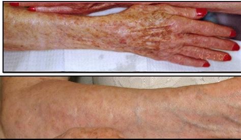 Aesthetic Treatments Before And After Impressions Medispa