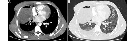 Axial Post Contrast Ct Image Of The Chest In The Mediastinal Window A
