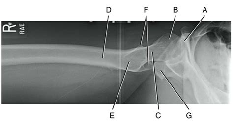 Bontrager Radiographic Positioning Chapter 6 And 7 Exam Flashcards Quizlet