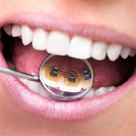 Want To Hide Your Braces Choose Lingual Braces Which Are Totally