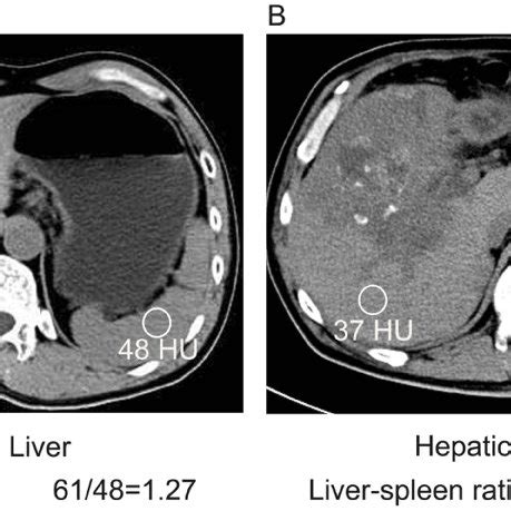 Measurement Of Hepatic Steatosis Using Non Enhanced Abdominal CT Download Scientific Diagram