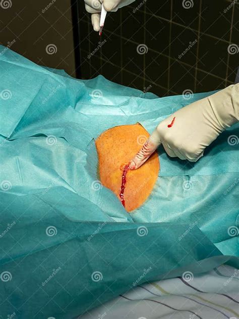In The Operation An Abscess Is Opened By A Doctor Stock Image Image