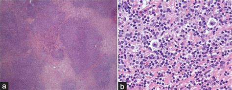 Photomicrograph Of The Lymph Node Biopsy A Showing Nodular Sclerosis