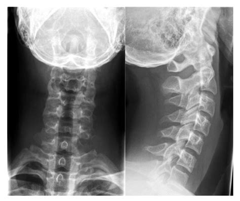 X Ray Cervical Spine Ap Lateral Stockstere