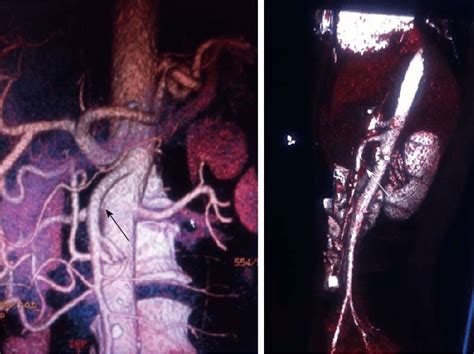 Major Intensity Projections Computed Tomography Reconstructions Can Download Scientific Diagram