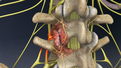 Lumbar Foraminotomy