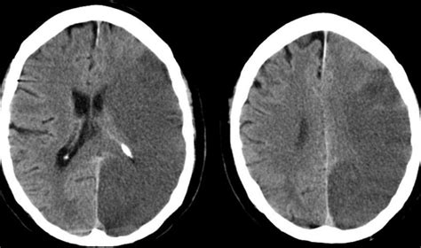 Infarction 2015