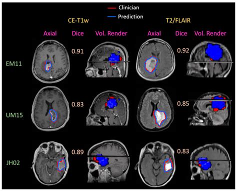 A Fully Automated Post Surgical Brain Tumor Segmentation Model For Radiation Treatment Planning