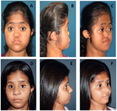 Congenital Adrenal Hyperplasia Women Congenital Adrenal Hyperplasia