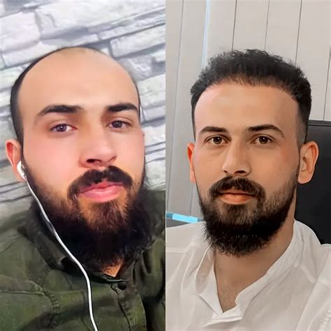 Hair Transplant Before And After Internationalclinics 2025