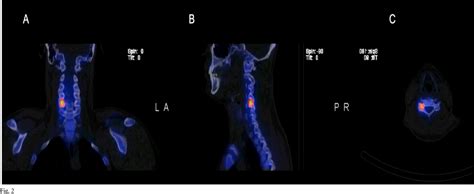 Figure 2 From En Bloc Resection Of Cervical Spine Osteoid Osteoma With