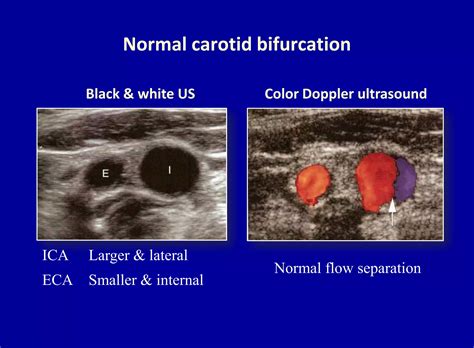 Doppler Ultrasound Of Carotid Arteries Pptx