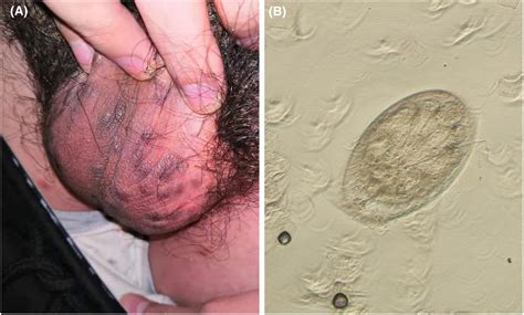 Scrotal Nodular Scabies Sang 2024 Clinical Case Reports Wiley