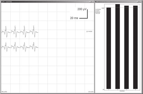 Train Of Four Tof Data Showing All Four Twitches Present Download Scientific Diagram