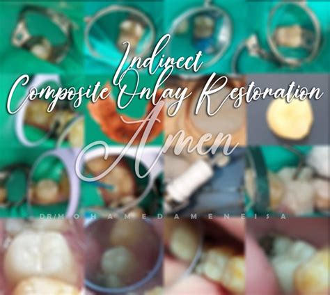 Indirect Composite Onlay Restoration Myzerodonto