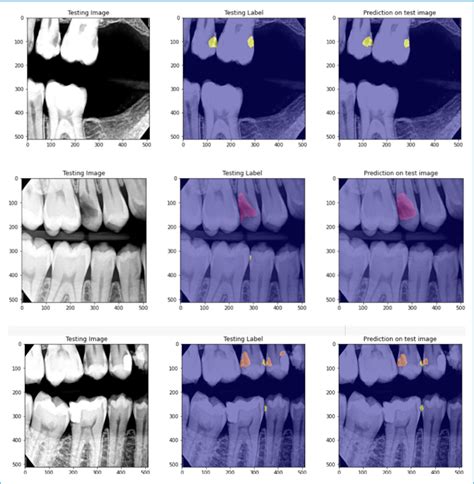 Figure 1 From Artificial Intelligence Ai In Restorative Dentistry Performance Of Ai Models
