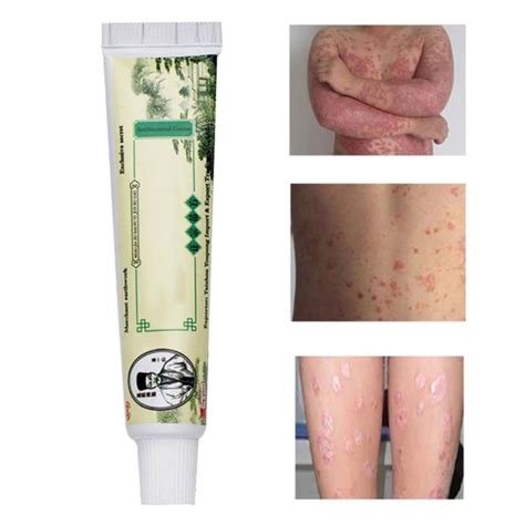 15 G Kinesisk Urte Psoriasis Hudpleje Dermatitis Eksem Pruritus