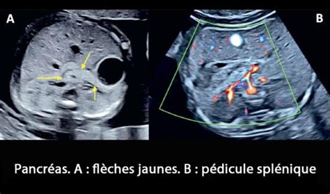 Pancréas Dr KARA ZAITRI M A