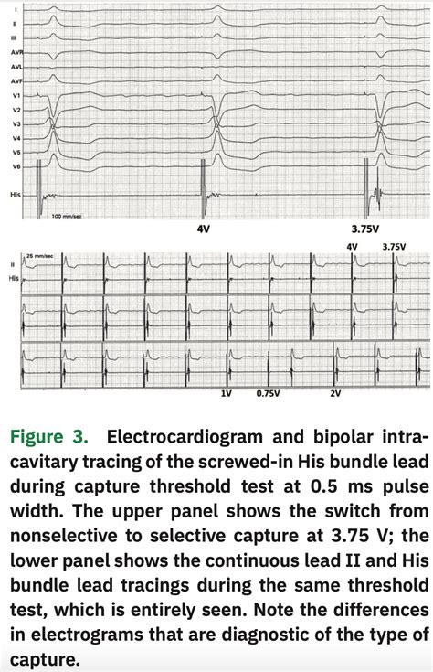 Atrioventricular Node Ablation Combined With His Bundle Pacing To Reverse Atrial Fibrillation