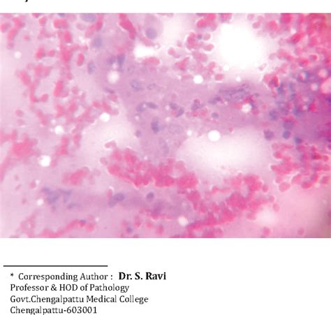 Figure 1 From Ossifying Fibromyxoid Tumour In A Rare Site Semantic