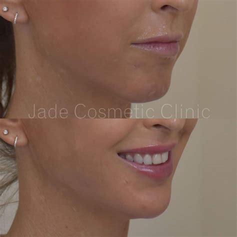 Dermal Fillers In Cairns Brisbane And Trinity Beach
