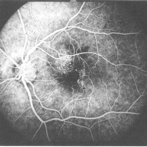 Fundusphotograph Showing Lamellar Macular Hole With Circinate Exudate Download Scientific Diagram