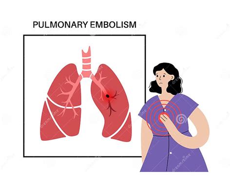 Pulmonary Embolism Disease Stock Vector Illustration Of Human 255910832