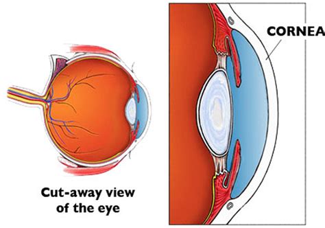 Cornea Specialist In Bangalore Best Corneal Transplant Surgeons In Bangalore Cornea