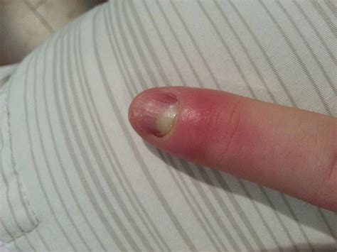 So My Cuticle Is Infected This Is Exciting R Popping