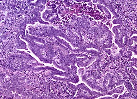 Endometrial Adenocarcinoma At 10x Magnification Microscopyu