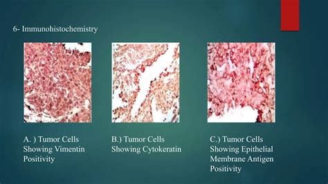 Sarcoma Pptx
