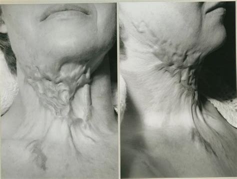 Burn Victims