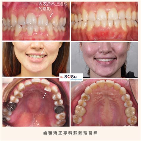 隱適美矯正 不拔牙可以改牙齒凌亂嗎 矯正專科蘇懿瑄醫師