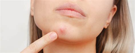 What Happens To The Pus In A Pimple If You Dont Pop It