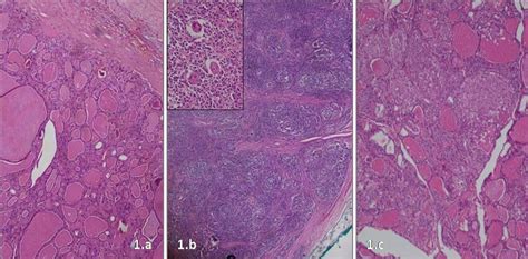A Photomicrograph Showing A Case Of Nodular Colloid Goitre Hande100x