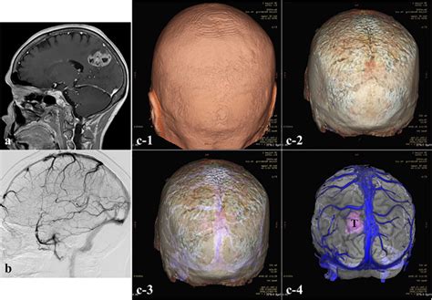 Clinical Utility Of New Bone Imaging Using Zero Echo Time Sequence In