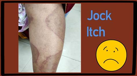 Jock Itch Bumps