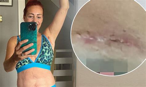 Sarah Cawood 50 Shows Off Her Very Neat Lumpectomy Scars Two Weeks Post Surgery Daily Mail