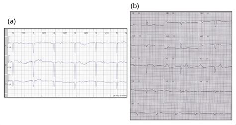 A Intraventricular Conduction Abnormality And 2 1second Degree