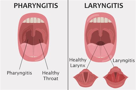 Is Viral Pharyngitis Contagious