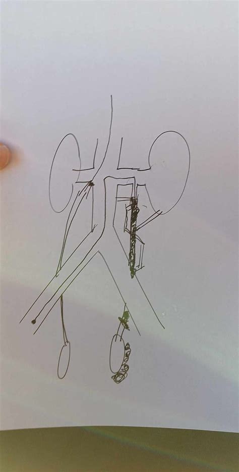 29 Varicocele Embolisation Story Uk Cautiously Optimistic R Varicocele