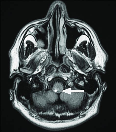 Flair Weighted Mri Magnetic Resonance Imaging Sequence Showing