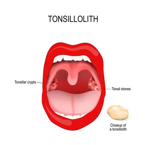 Tonsil Vector Art Stock Images Depositphotos