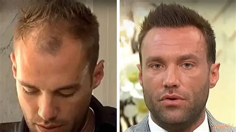 The Transformative Journey Of Celebrity Hair Transplants Before And After